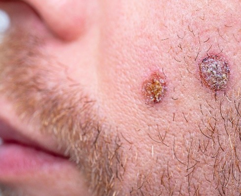 Ferida que não cicatriza: principais causas - leia agora!